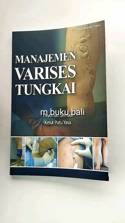 Manajemen Varises Tungkai | Lazada Indonesia