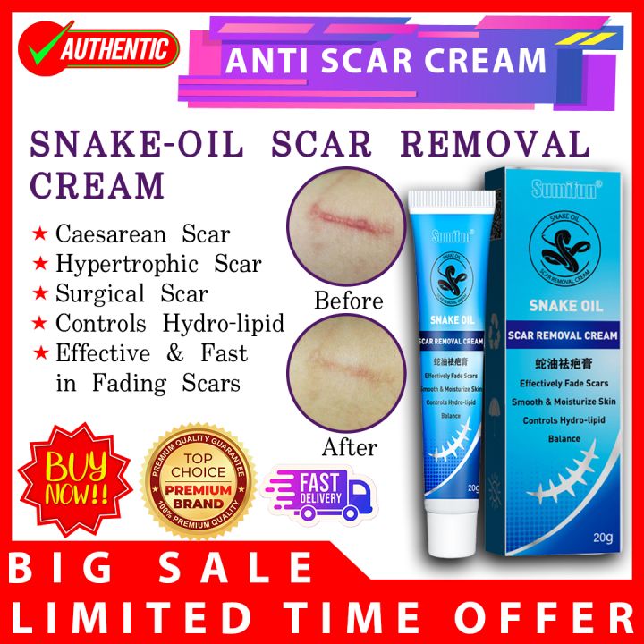 SNAKE OIL Scar Removal Cream Scar Gel By Doc Willie Ong Scars Remover ...