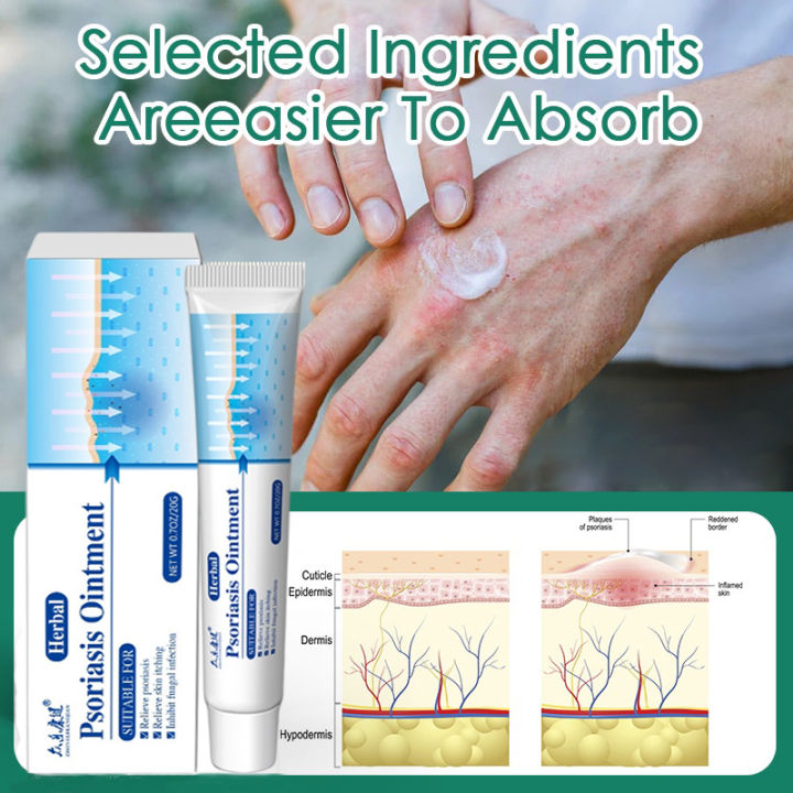 100% Original Authentic Eczema Cream Psoriasis Dermatitis Ointment Health Itching Relief Skin ...