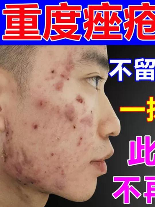 Rose Acne Special Effect Medicine Facial Head Propionibacterium Barrier ...