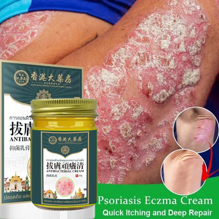 Eczema Treatment Cream Relieves Itching and Scars Inhibits Bacterial ...