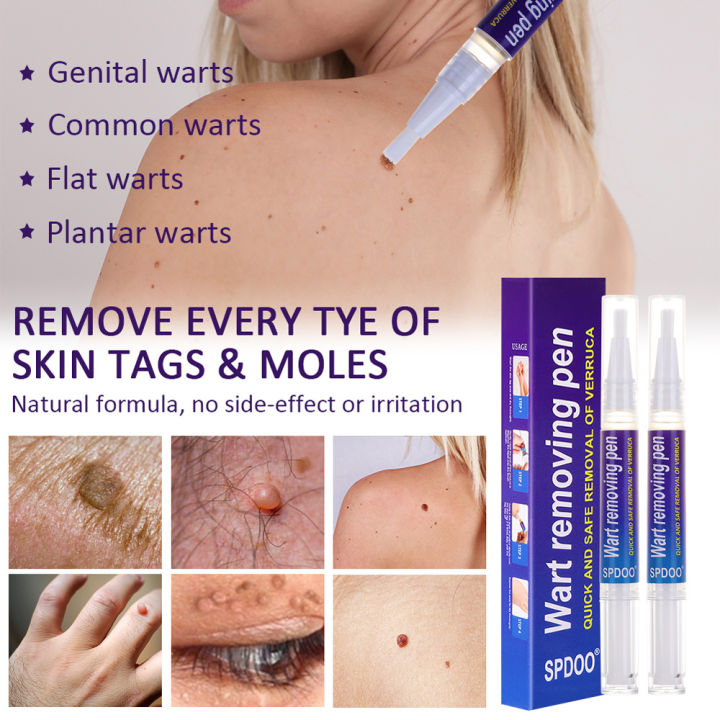 Skin Tag Remover Eliminate Warts Remover Cream Body Mole Wart Remover ...