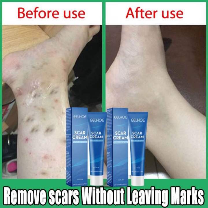 EELHOE salep penghilang bekas luka koreng luka bekas jaitan caesar dan ...