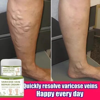 EELHOE Varicose Veins Cream Obat Varises Salep Penghilang Varises ...