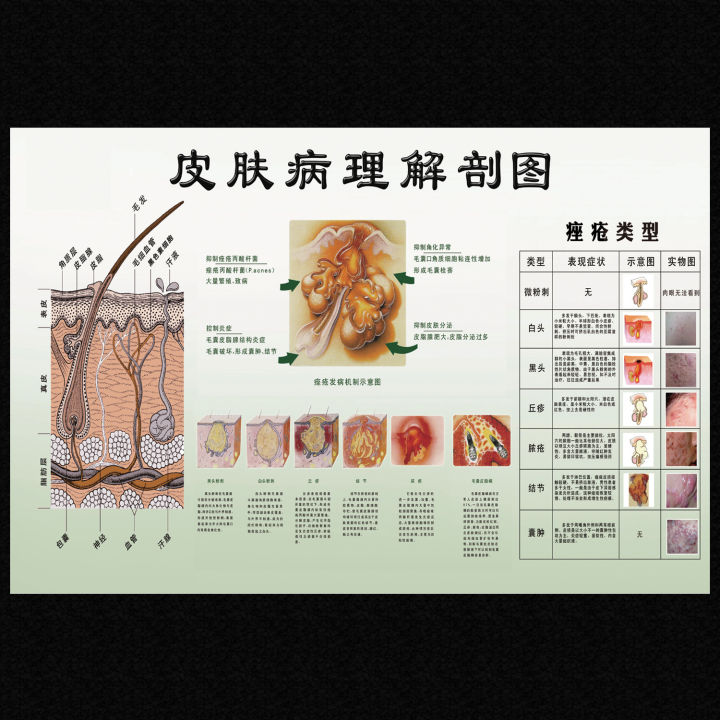 Common Atlas of Skin Diseases Causes of Acne and Pigmentation Hospital ...