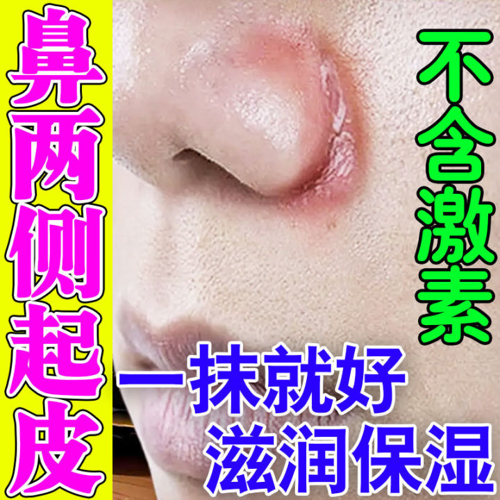Red Dry Itchy Nose Groove Bilateral Flaking Red Nose Tip Seborrheic ...