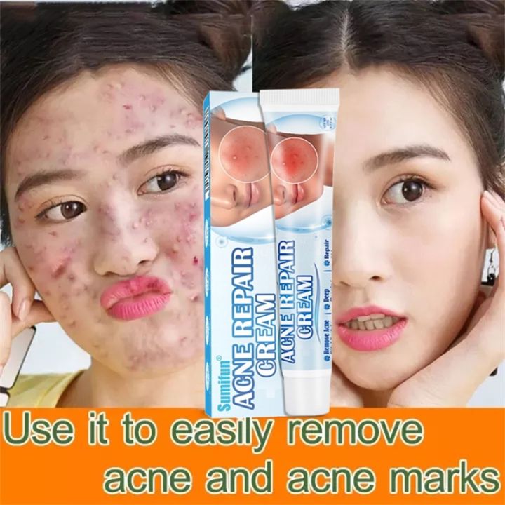 Sumifun Acne Scars Remover For Face Pimples Acne Remover Best Seller Scar Gel Pimple Quickly ...