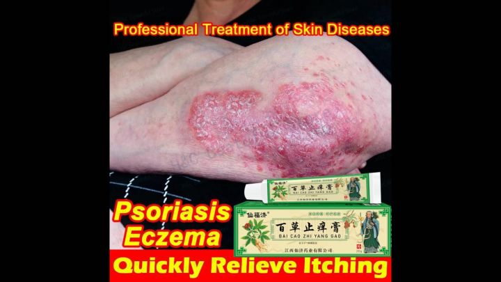 ubat gatal cina krim gatal eczema krim Eczema Cream Antibacterial ...
