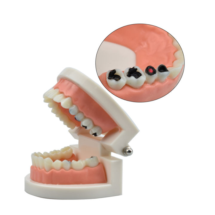 Teeth Model Children Kid Teaching Study Demonstration Tooth Model ...