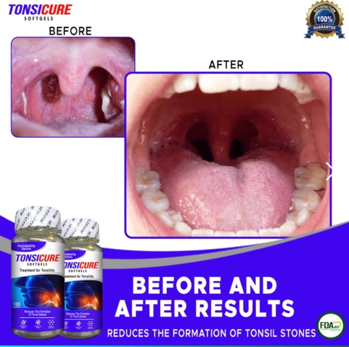 Tonsicure treatment for tonsillitis | Lazada PH