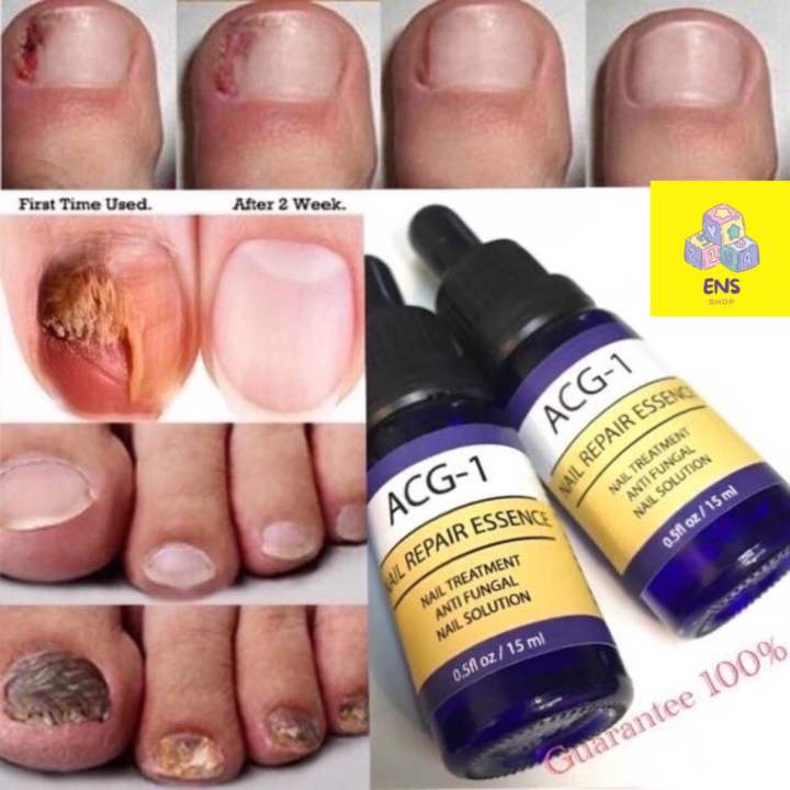 น้ำยารักษาเชื้อราใต้เล็บ ACG-1 รับประกันได้ผลดีแน่นอน สินค้ามีพร้อมส่ง ...