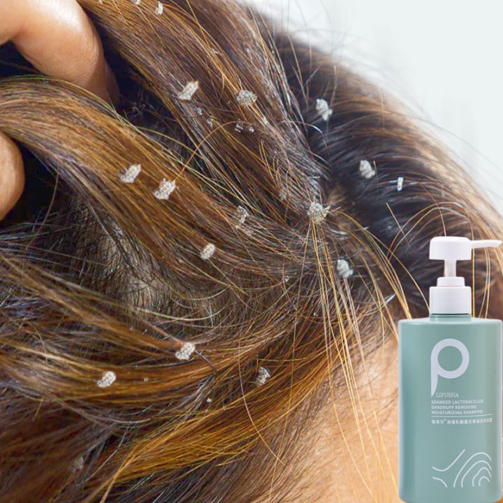 Shampo buat ketombe Shampoo penghilang ketombe anti gatal pengobatan ketombe penghilang tungau ...