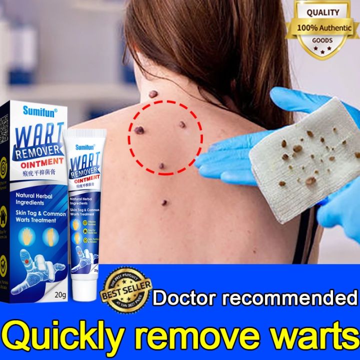 Warts Remover Original Cream Warts Magic Remover Wart Ointment Original ...