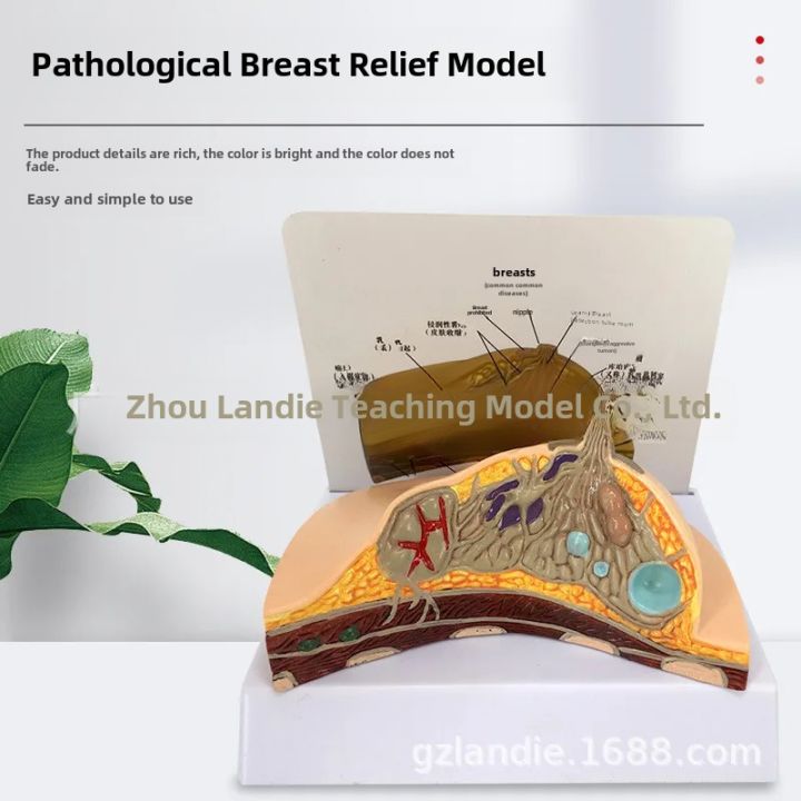 Breast Pathology Model Breast Disease Model Lactation Training ...