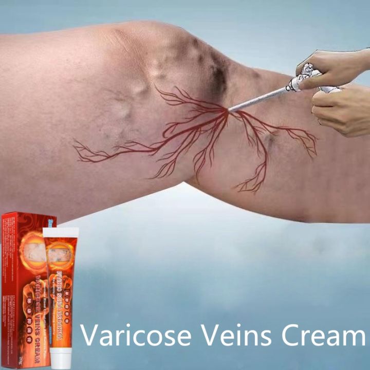Varicose Veins Treatment Cream Vasculitis Phlebitis Spider Ointment ...
