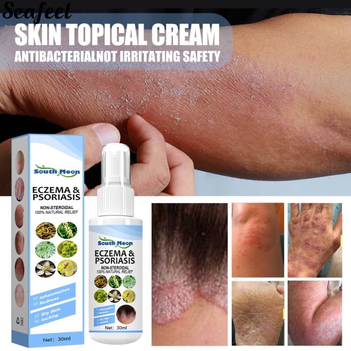 Eczema and psoriasis treatment spray for skin diseases antifungal, anti ...
