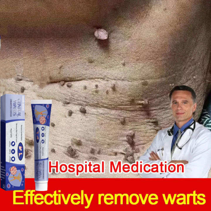 Ubat buang kutil ketuat tahi lalat biji kolestrol Wart Cream Wart ...