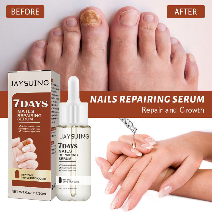 Nail Repair Essence Ingrown Toenail Soften Nail Repair Thickening ...
