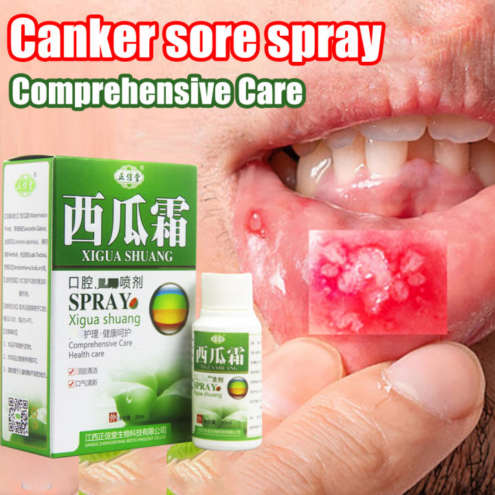 Oral Ulcer Spray Natural Herbal Mouth Ulcer care Spray 30ml Ulser HFMD ...