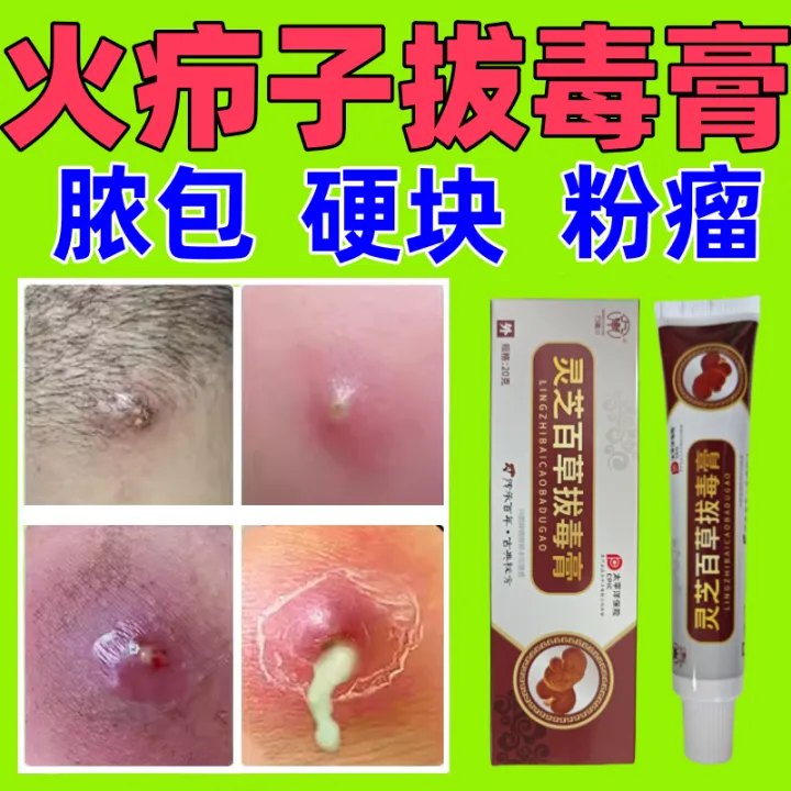 Pustule Abscess Extracting Ointment Butt Lump Pus Pack Red Bump Sitting ...