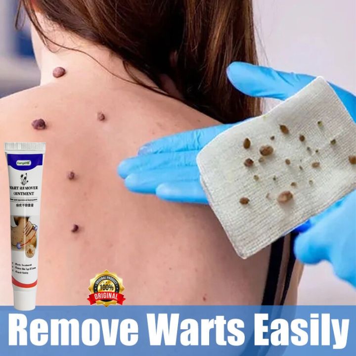 skin tags remover wart removal cream 20g mole remover skin tag Foot ...