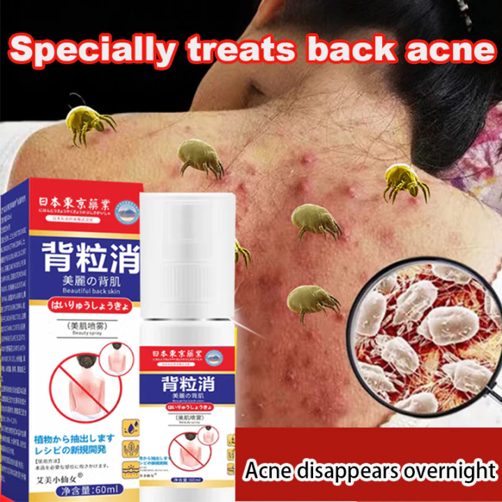 Japan Acne Body Spray Acne Remove Spray 60ml Remove Mites Remove Acne ...