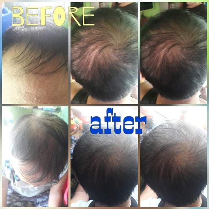 Hair problem solution Hairbal trio( shampoo, conditioner and serum) by ...