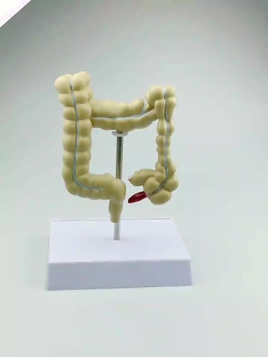 Colorectal Lesion Model Human Colon Snake Large Intestine Pathological ...