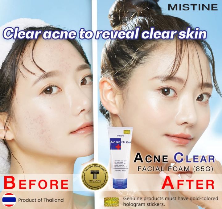 Mistine Acne Clear Cleansing Whitening Foam | Lazada