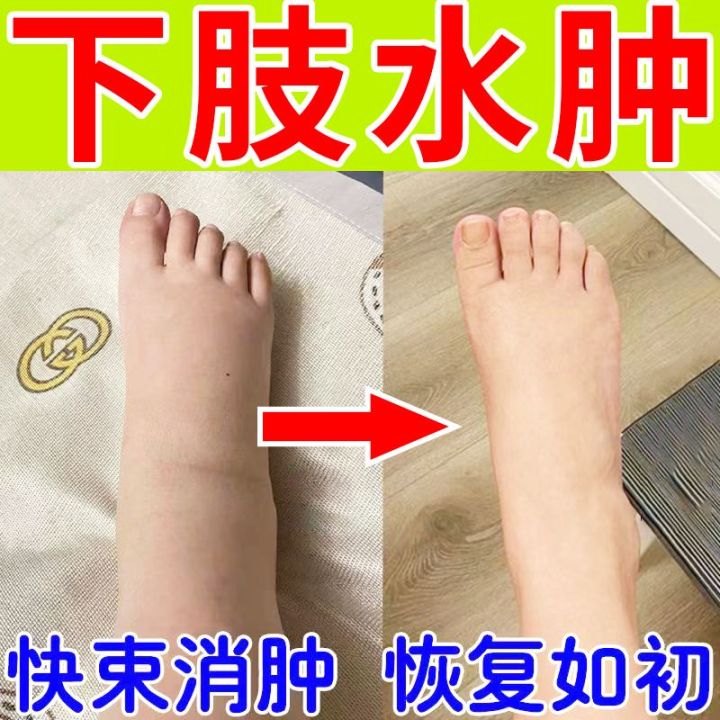 Leg and Foot Edema Lower Limb Edema Elderly Foot Swelling Limb Edema ...