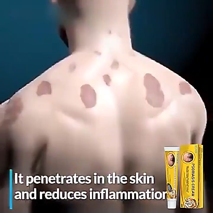 Psoriasis cream 20g Relieves itching and scars,inhibits bacterial ...