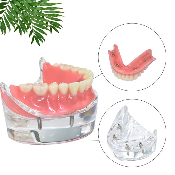 Dental Implant Teeth Model 4 Implants Overdenture Removable Bridge ...