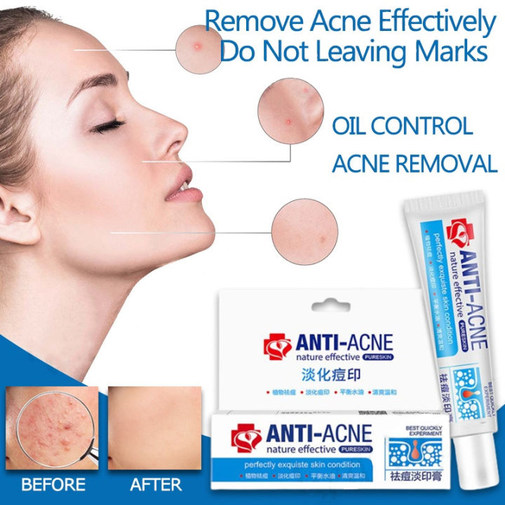 Remove Pimples Quickly Pimple Remover Acne Cream Fades Acne Marks Repairs Acne Pits Facial Scar ...