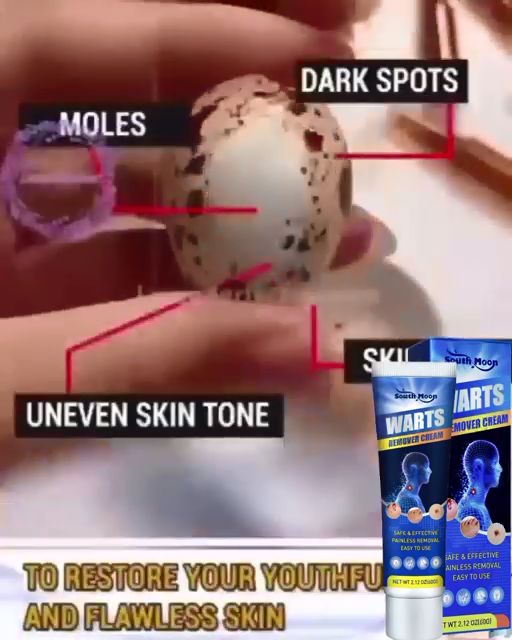 💖Safe Painless💖 60g Wart Removal Ointment Wart Remover Cream Wart ...