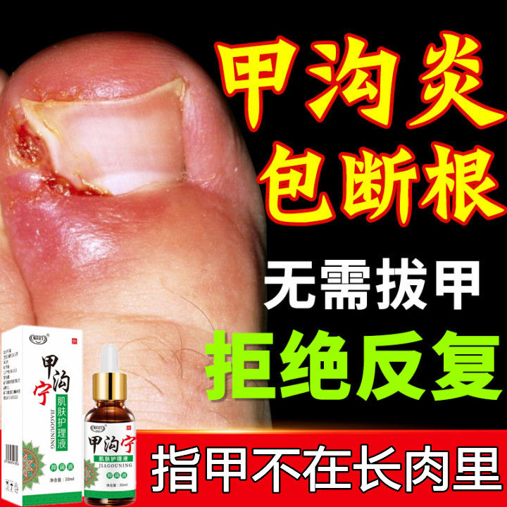 Paronychia Treatment Handy Gadget Special Purpose Chemicals Pain Fester ...