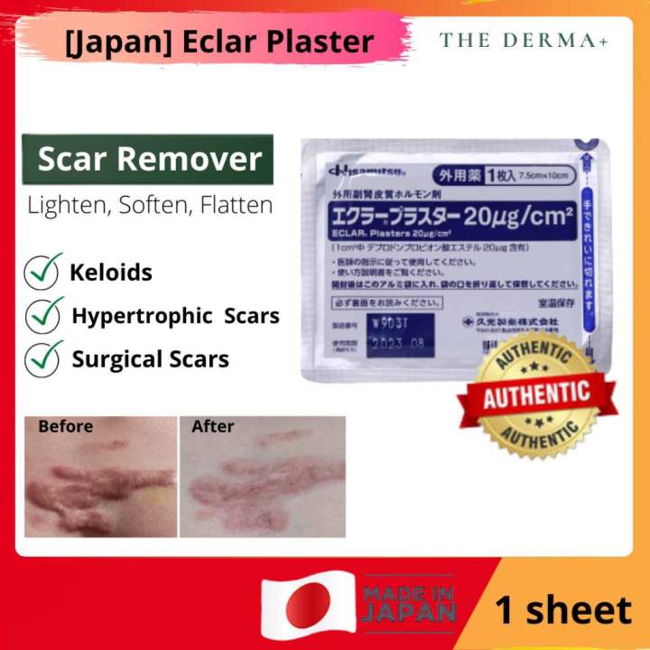 [Japan] Scar Removal / Keloid Treatment - Hisamitsu Eclar Plaster ...