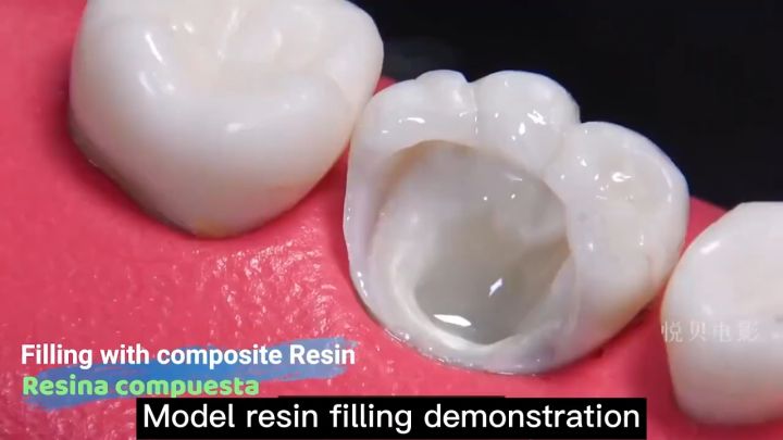 Dental Light Curing Composite Resin Universal Adhesive Bonding Filling ...