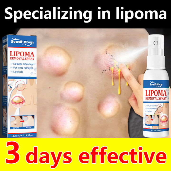 【Painless】Lipoma Removal Spray 50ml lipoma removal cream original Japan ...