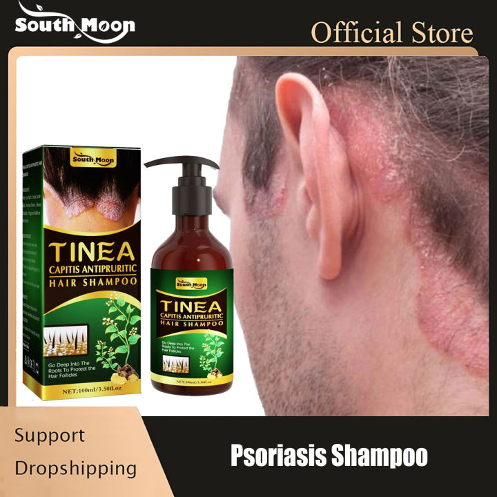 Psoriasis Shampoo Treatment Dermatitis Eczema Tinea Capitis Itching ...
