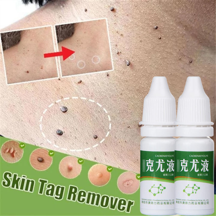 100% Original and Effective Wart removal Oil Warts Remover Original ...