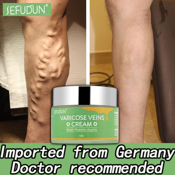 SENLOVE Original Varicose Vein Treatment Cream 50g 100% original Anti ...