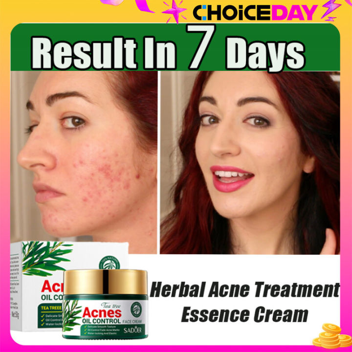 Pimples Remover Effective 50g Refreshing Anti Acne Cream Controls Acne ...