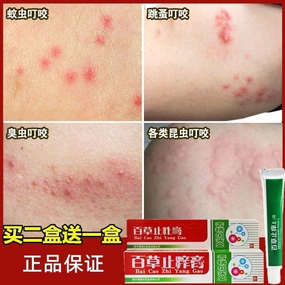 Flea Anti-Itching Cream Bug Bite Plaster Children Baby Mosquito Ant ...