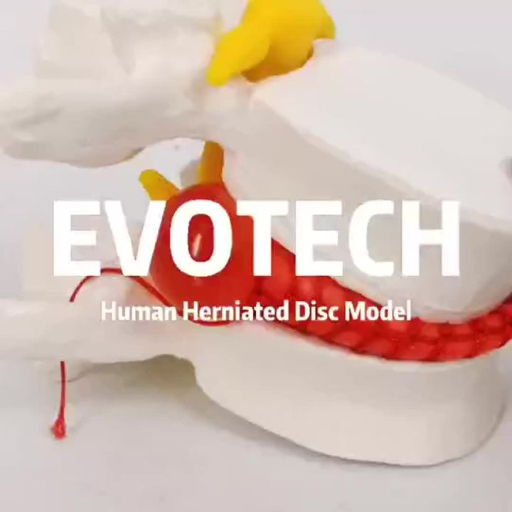 Human Herniated Disc Model, Anatomical Herniated Lumbar Vertebrae Disc ...