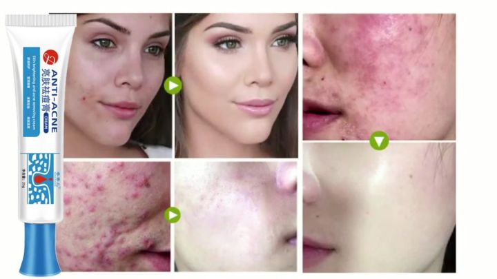 SENLOVE 100% Effective Remove Pimples Quickly Acne Remover Cream Acne ...