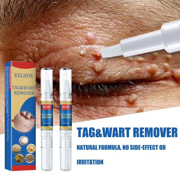 Effective Remover of Wart and Mole Skin Tag Removal Pen Remover Tool ...