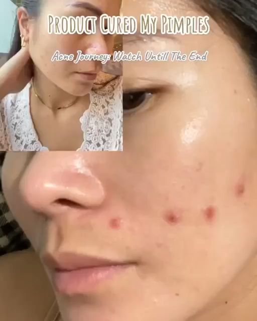 NEW IMPRROVED! Skin21 Acne Prone Starter Kit (Pimpleless Essentials ...