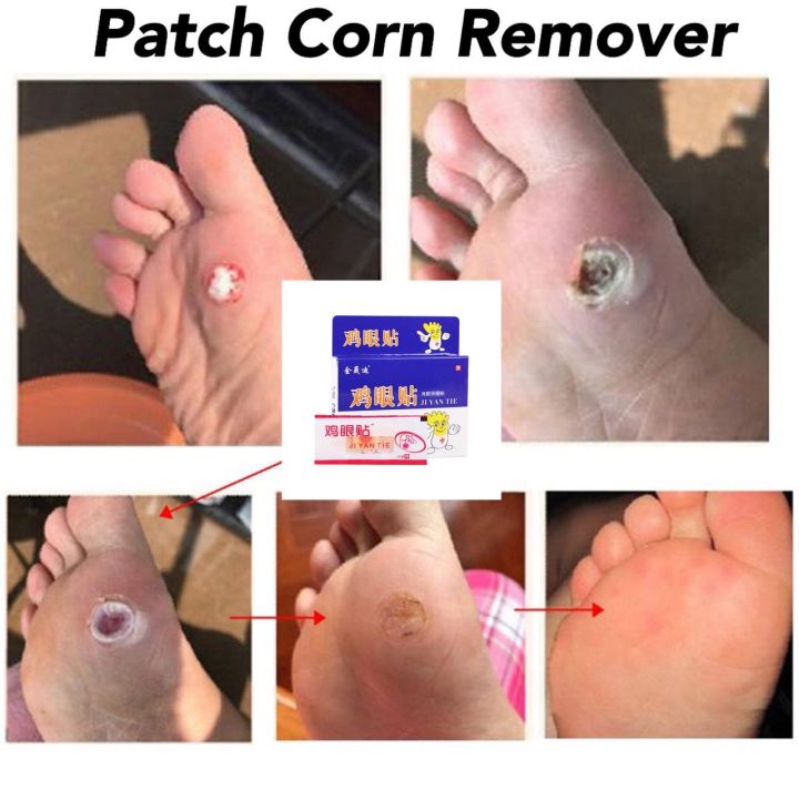 CORN PATCH BLUE BOX Corn remover skin tag remover Penanggal kutil ...