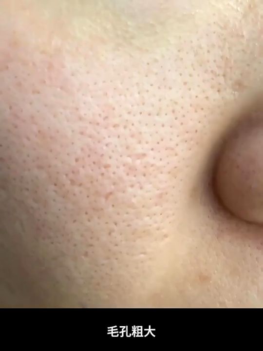 Pore essence lighten pigmentation remove acne marks refine pores ...