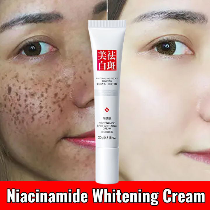 melasma and pekas remover cream original jekina melasma remover dark ...